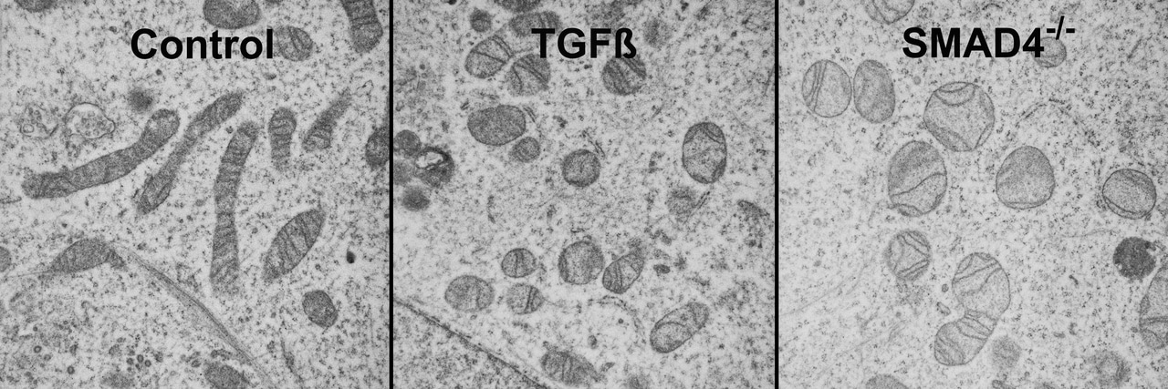Paradoxical role of SMAD4 loss in pancreatic cancer | Research ...