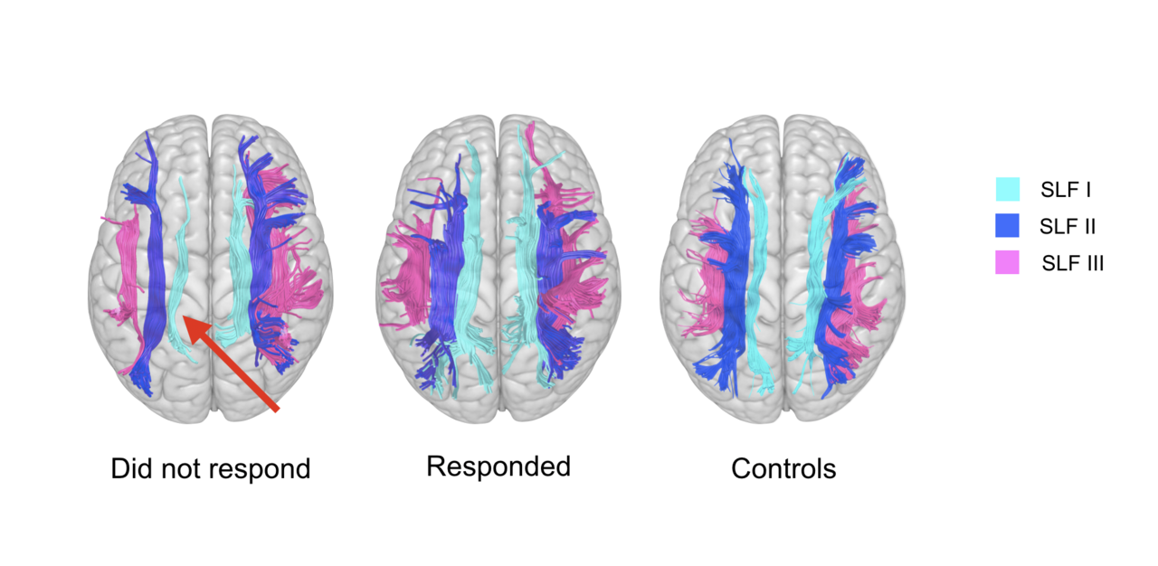 POOR RESPONSE TO METHYLPHENIDATE IS ASSOCIATED WITH A SMALLER DORSAL ...