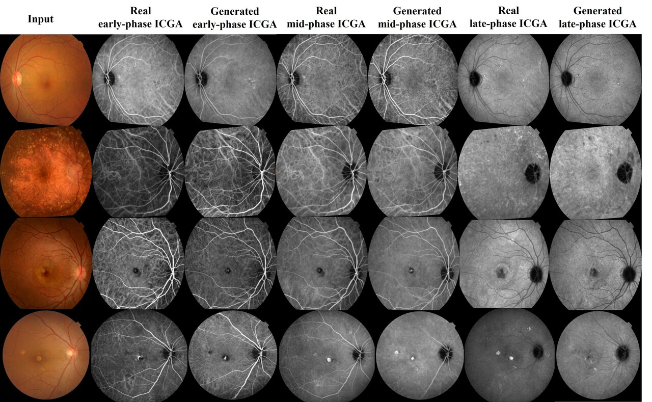 Generative AI: A Game-Changer in Age-Related Macular Degeneration Screening by Achieving ...