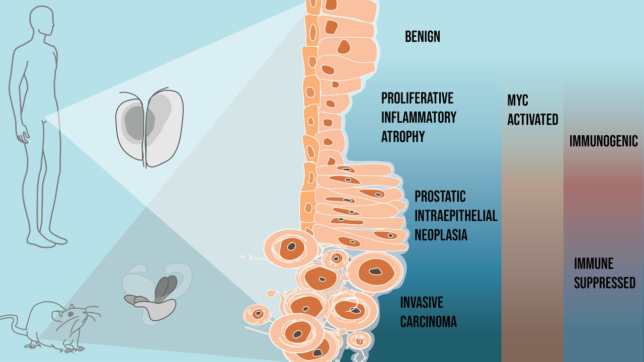 Navigating prostate cancer progression in humans | Research Communities ...