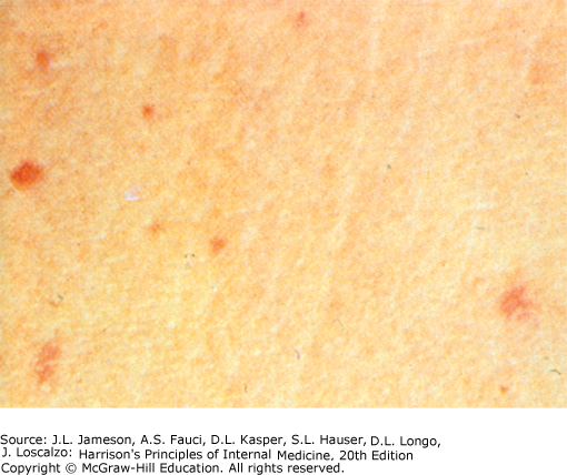 AccessMedicine's Image of the Week: Rose Spots Associated with ...
