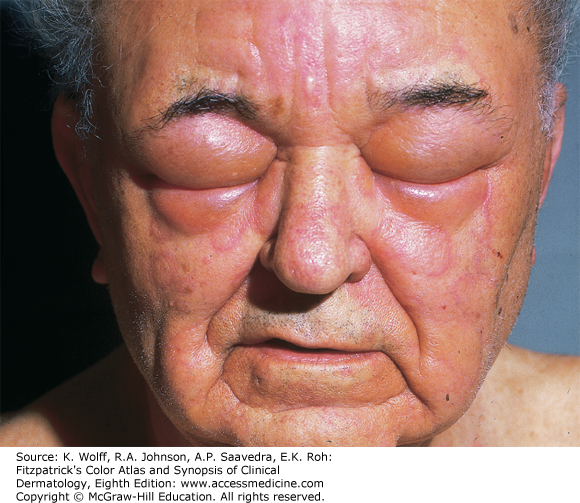 Acute Urticaria and Angioedema | AccessMedicine Network