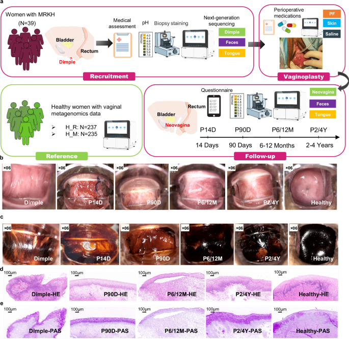 A Collaborative Journey in Unraveling the Assembly of Neovaginal Microbiota in MRKH Syndrome ...