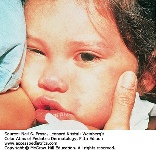 Collagen Vascular and Other Multisystem Disorders Case | AccessMedicine ...