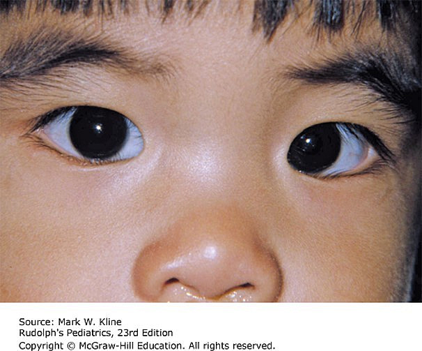 Strabismus Diagnosis | AccessMedicine Network