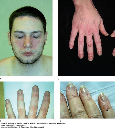Inflammatory Myopathies Diagnosis | AccessMedicine Network