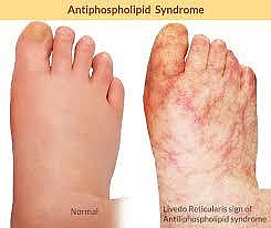 Atypical Wounds - Antiphospholipid syndrome | AccessMedicine Network