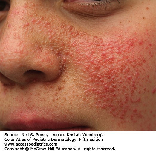 Genodermatoses Diagnosis | AccessMedicine Network