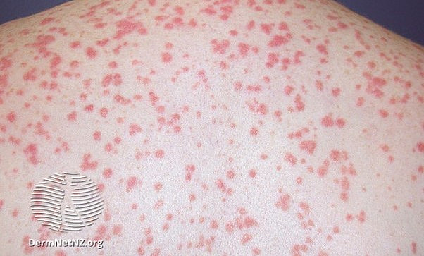 Sudden onset of itchy, scaly rash | OnMedica