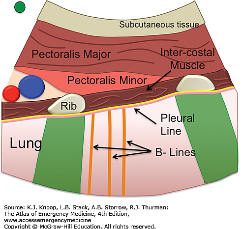 AccessMedicine's Image of the Week: B-Lines on Lung Ultrasound ...