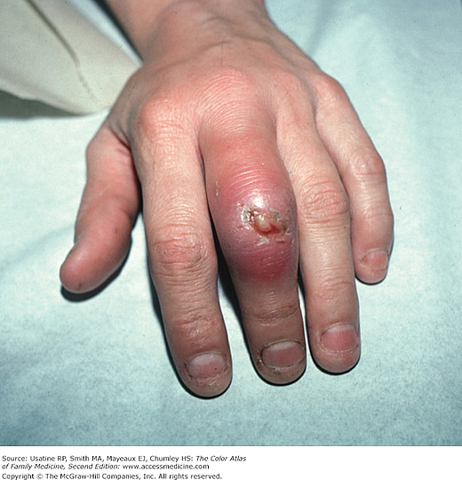 Cellulitis | AccessMedicine Network
