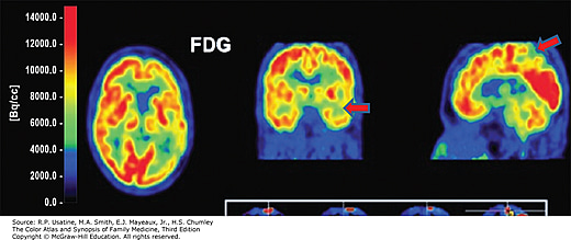 PET Imaging of Brain with Alzheimer Disease | AccessMedicine Network
