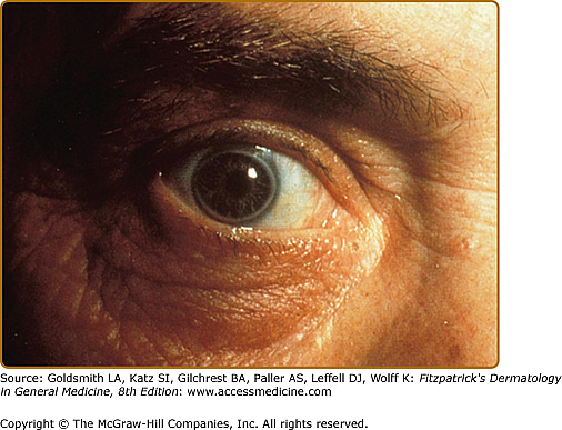 Arcus Senilis in Familial Hypercholesterolemia | AccessMedicine Network