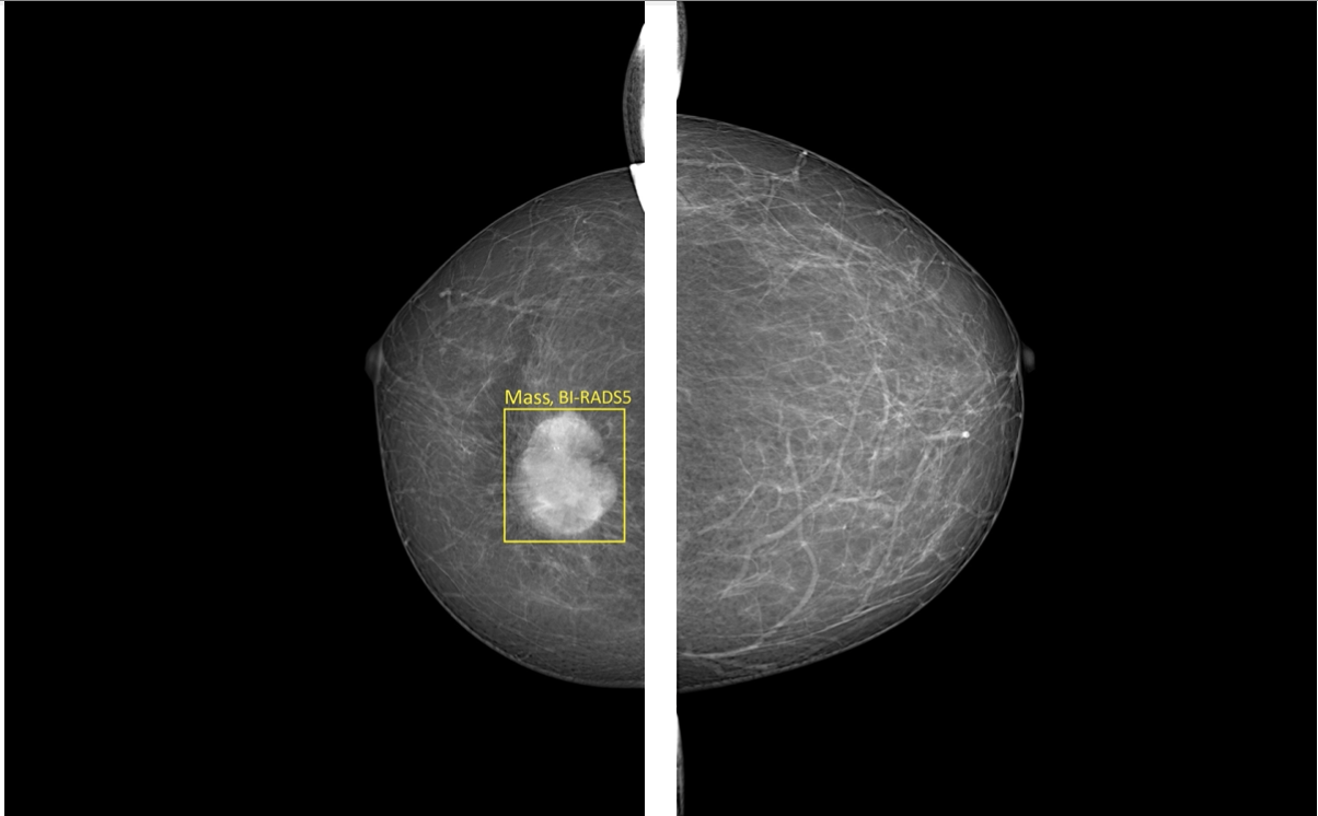 VinDr-Mammo: The largest public dataset of full-field digital mammography to evaluate and ...