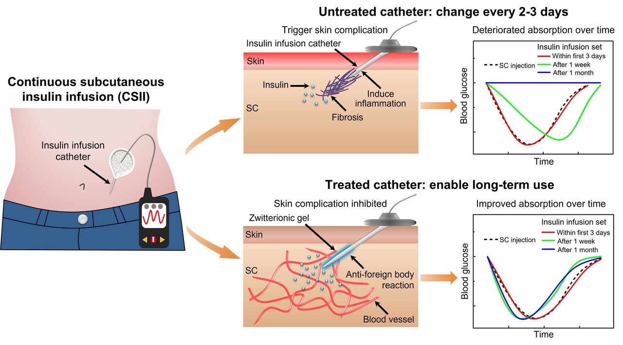 Zwitterionic “Implant Mate” enables long-term use of subcutaneous insulin infusion catheters and ...