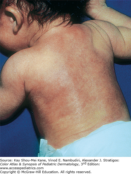 Subcutaneous Fat Necrosis Of The Newborn