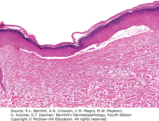 Porphyria Cutanea Tarda Histology A 9‐year‐old Girl With Blisters